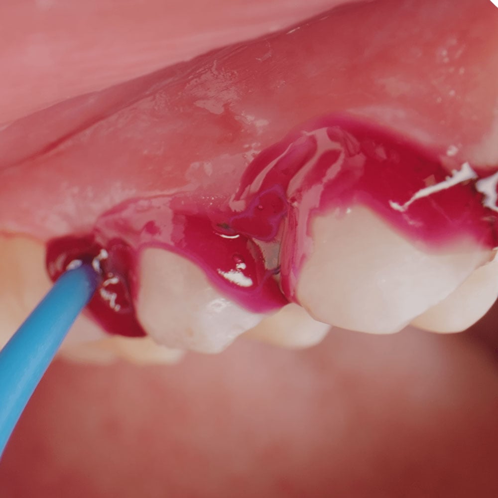 How PerioDT® Became a Game-Changer in My Hygiene Practice