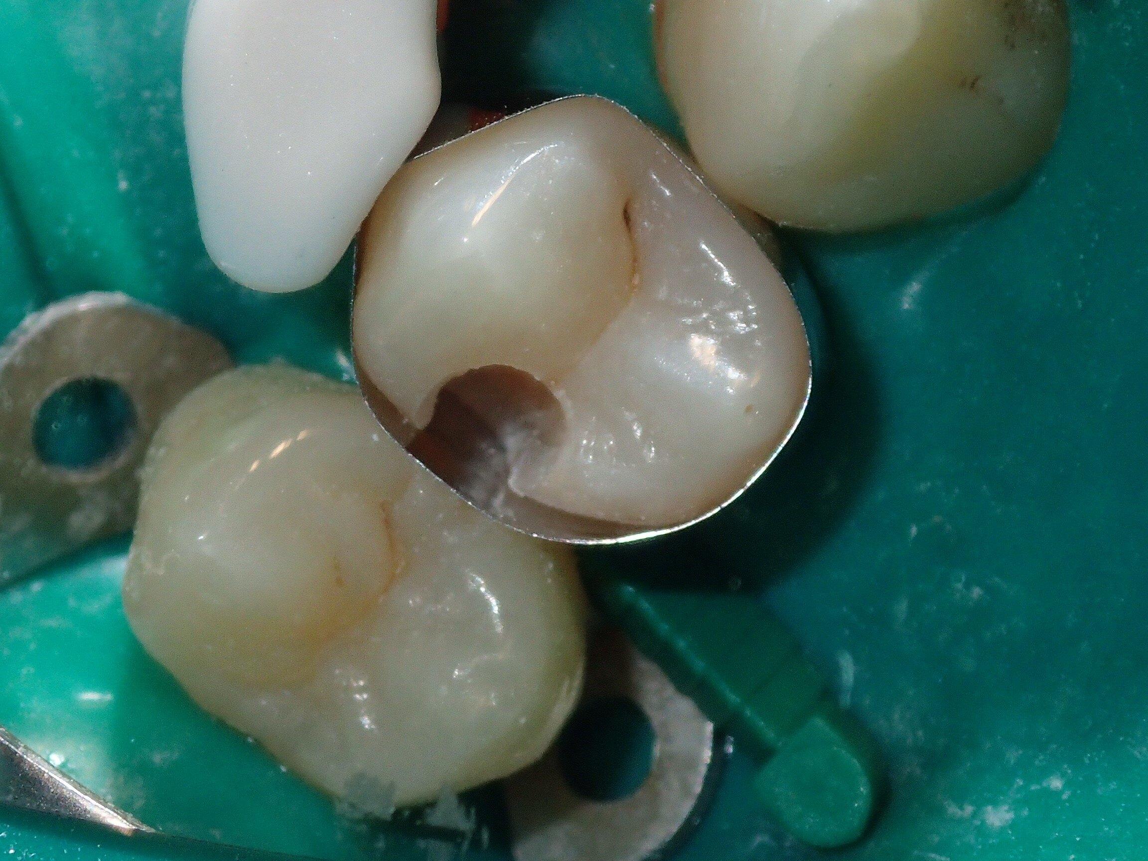 Tofflemire vs. Pre-Assembled Matrix Systems: Faster Restorations ...